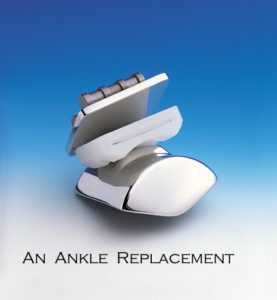 Ankle Replacement - The Foot and Ankle Clinic