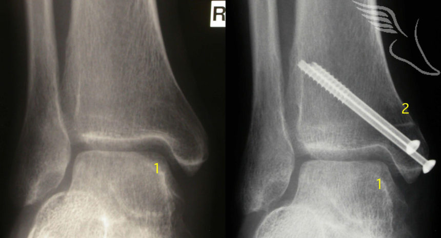 Osteochondral Defect - The Foot and Ankle Clinic