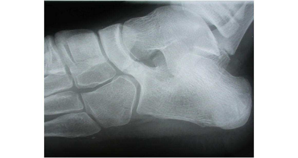 The Flat Foot - The Foot and Ankle Clinic